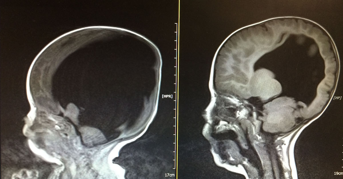 Baby With No Brain Has Miraculous Recovery