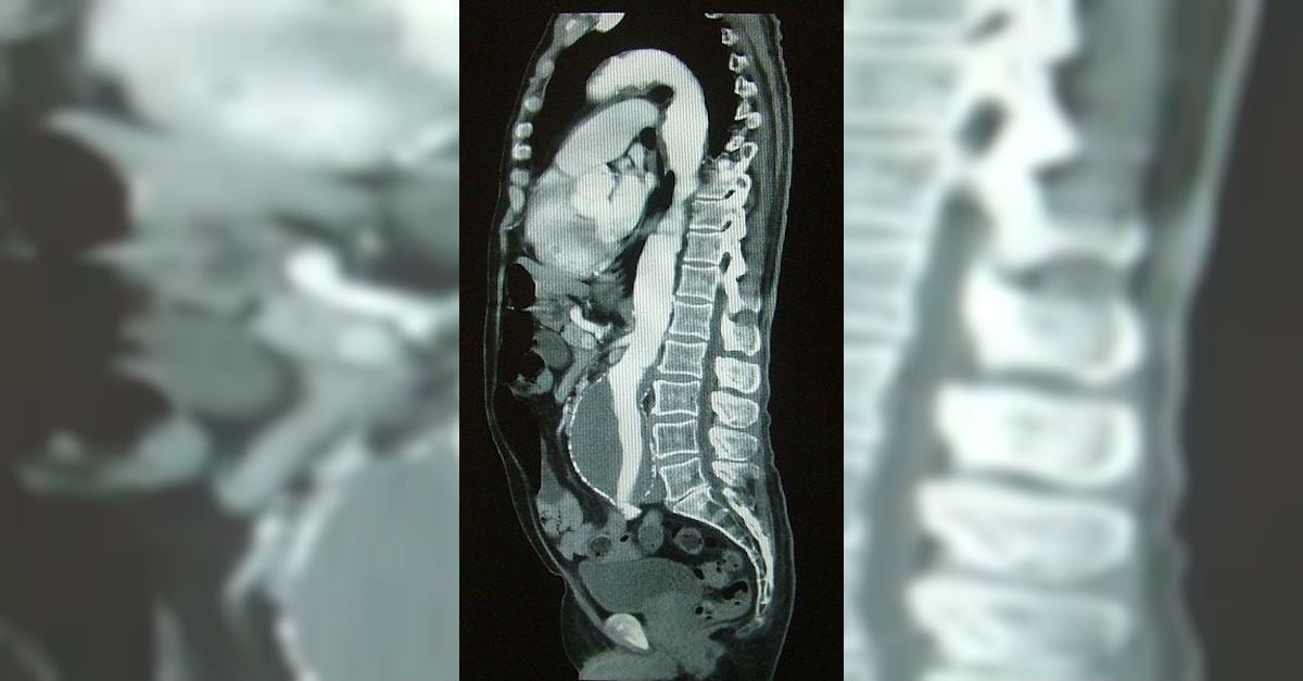 Aortic Aneurysm Signs That Everyone Needs To Know