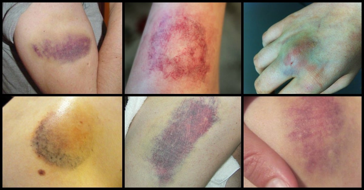 Learn How To Tell And Heal The 5 Different Shades Of Bruises