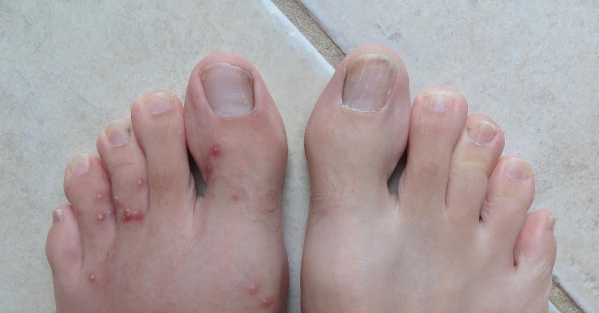 These Are The 8 Most Common Bugbites You Should Know