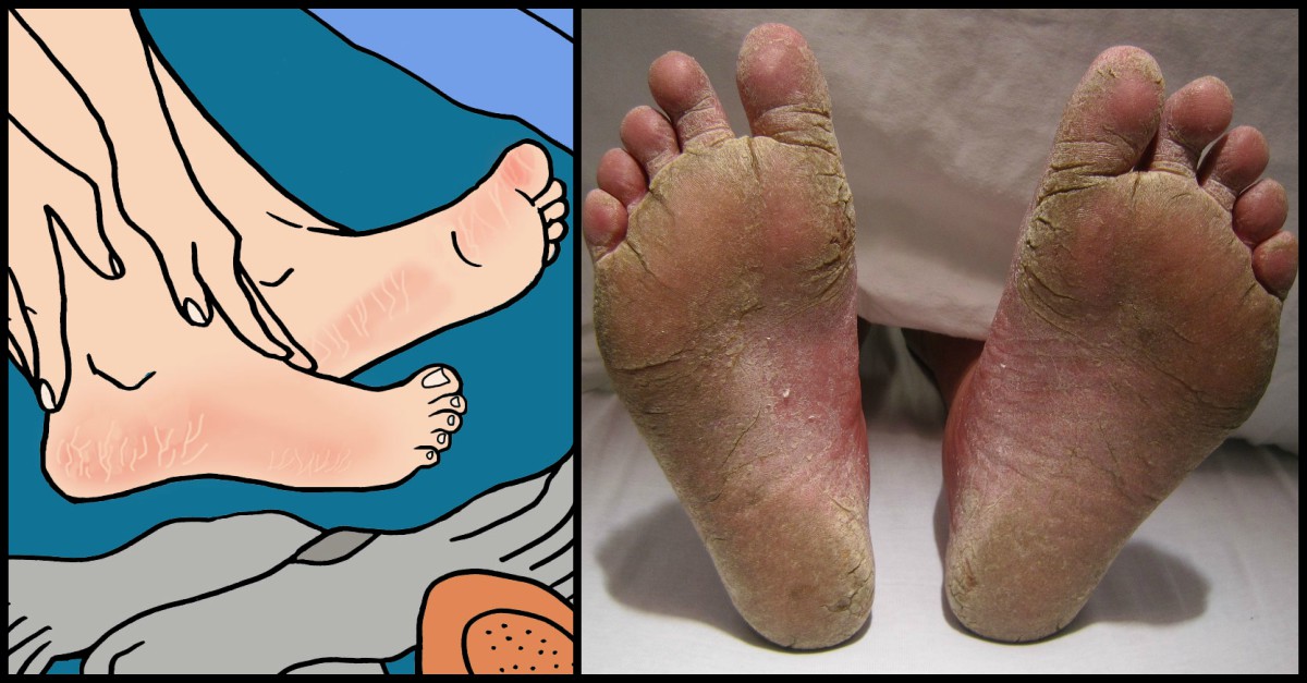 7 Alarming Reasons You Have Peeling Or Cracked Feet