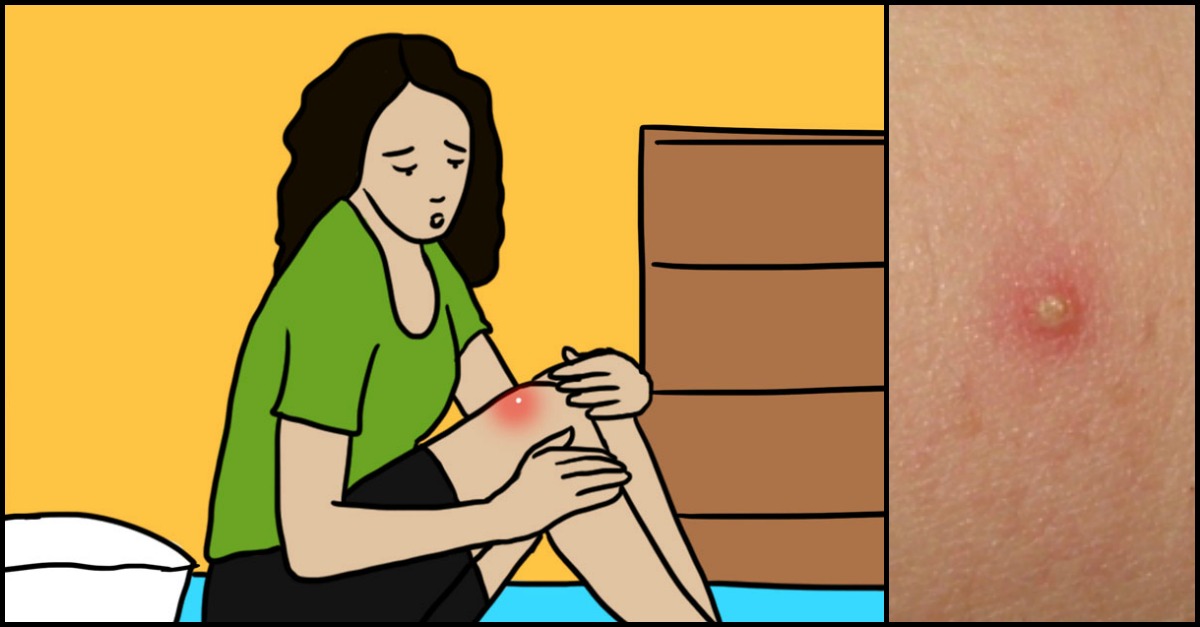 Get Rid Of A Boil In 6 Simple Steps Using Our Helpful Guide