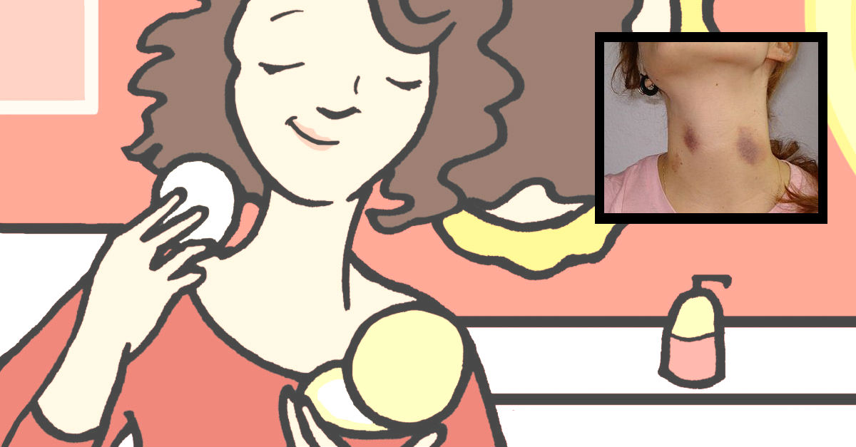 How To Get Rid Of A Hickey The Fast And Easy Way