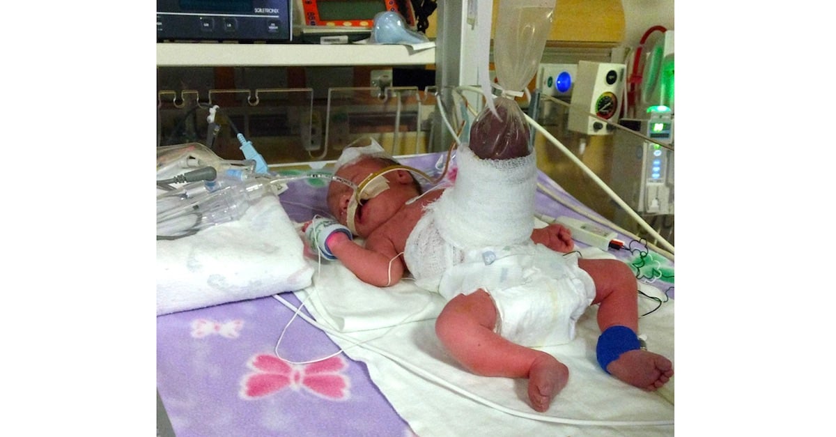 Premature Baby Is Born With Intestines Outside Body