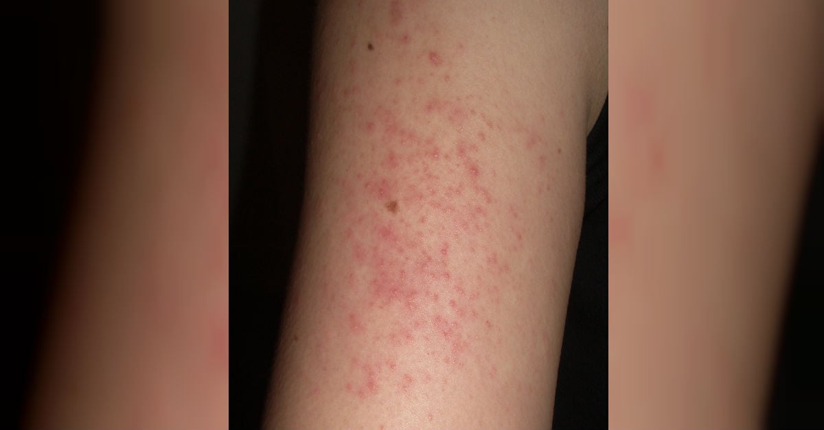 Get Rid Of Those Unsightly Skin Bumps Right At Home