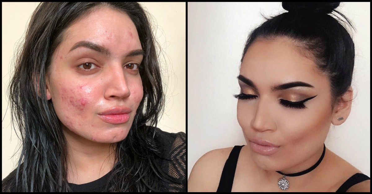 Makeup Artist Proudly Shows Off Acne To Remove Stigma