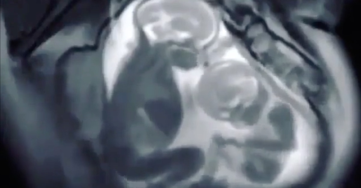 Identical Twins Squirm In The Womb At 20 Weeks In Unretouched MRI Video
