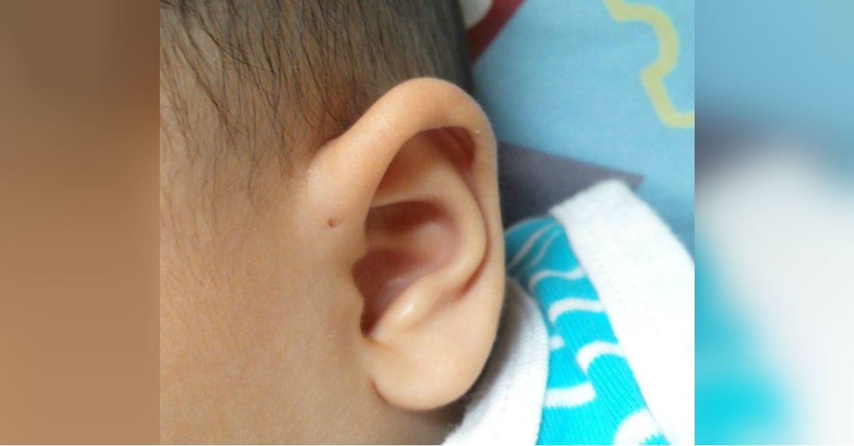 The Fascinating Reason Why Some People Have A Small Hole Above Their Ear