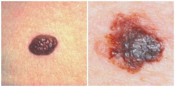 He Spots A Strange Mark On His Back. What It Means? I Had No Idea...