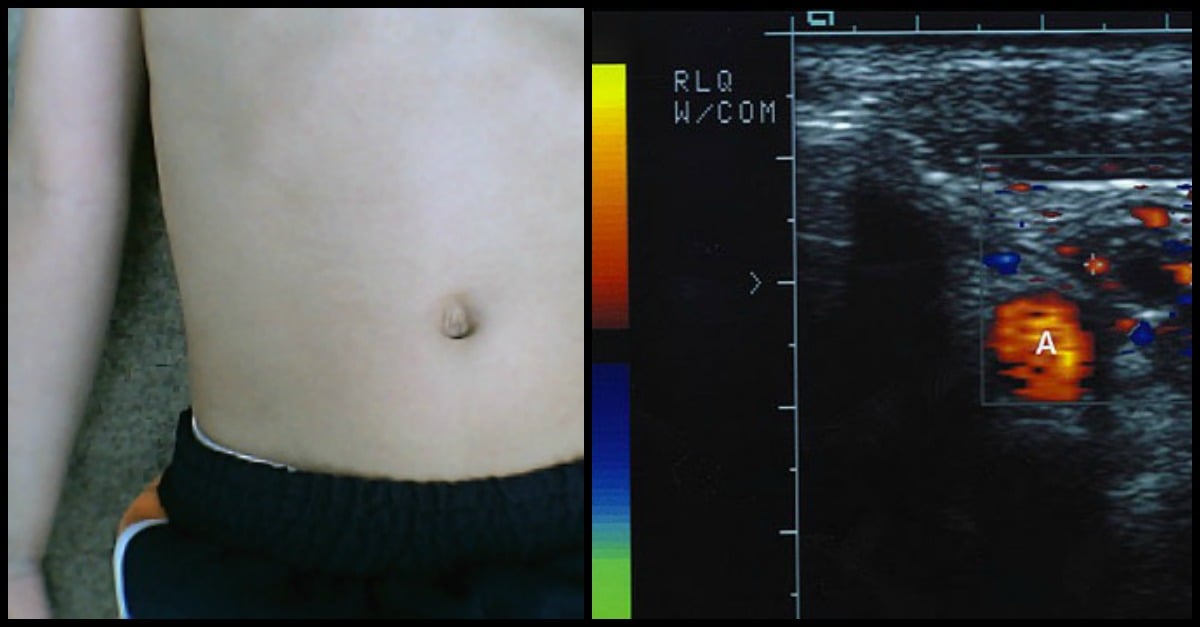 10 Appendicitis Symptoms In Children To Watch Out For