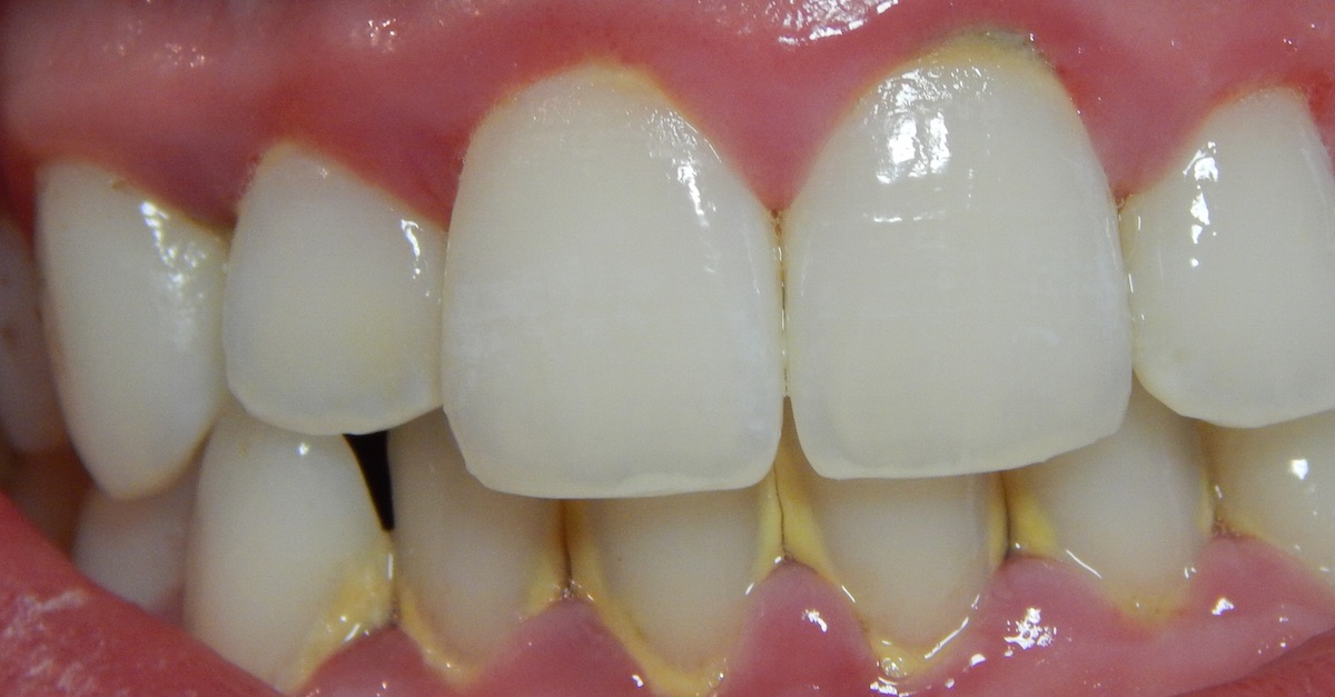 These Shiny Red Rings Could Mean Trouble For Your Gums. I Had No Idea!