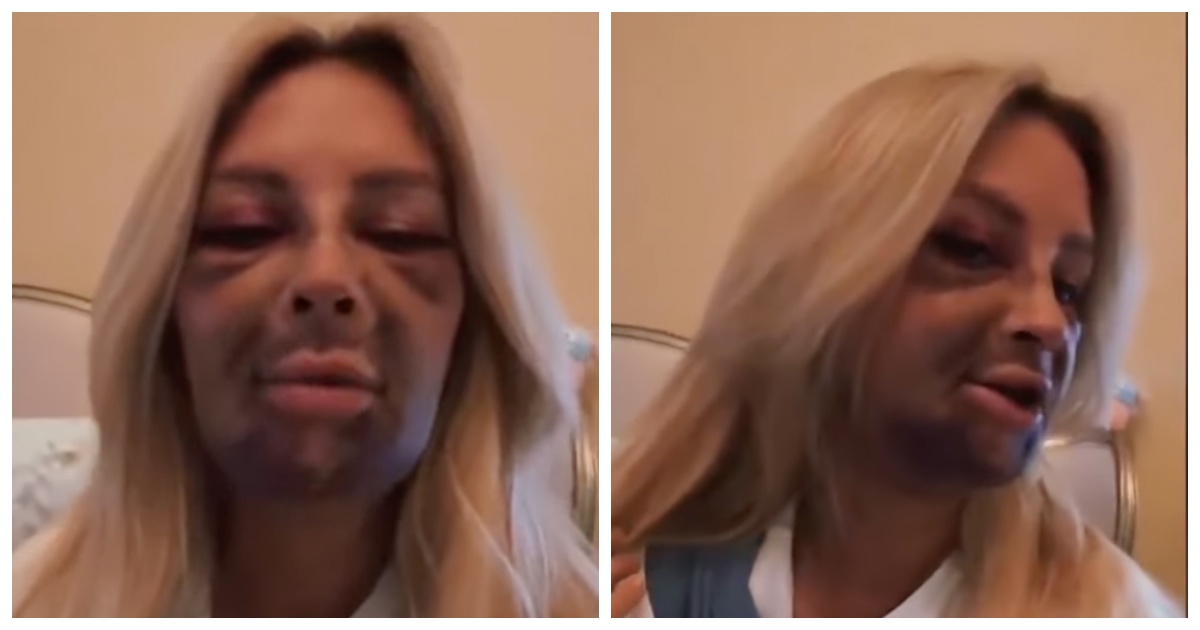 Woman's Dental Surgery And Implants Caused Severe Bruises