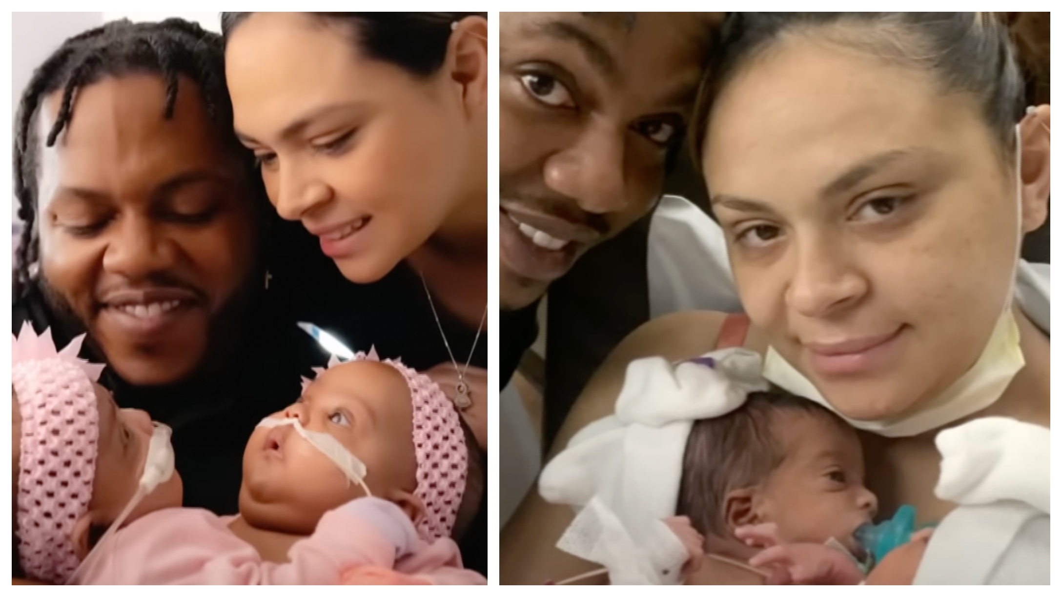 Rare Surgery Successfully Separates Conjoined Twin Girls