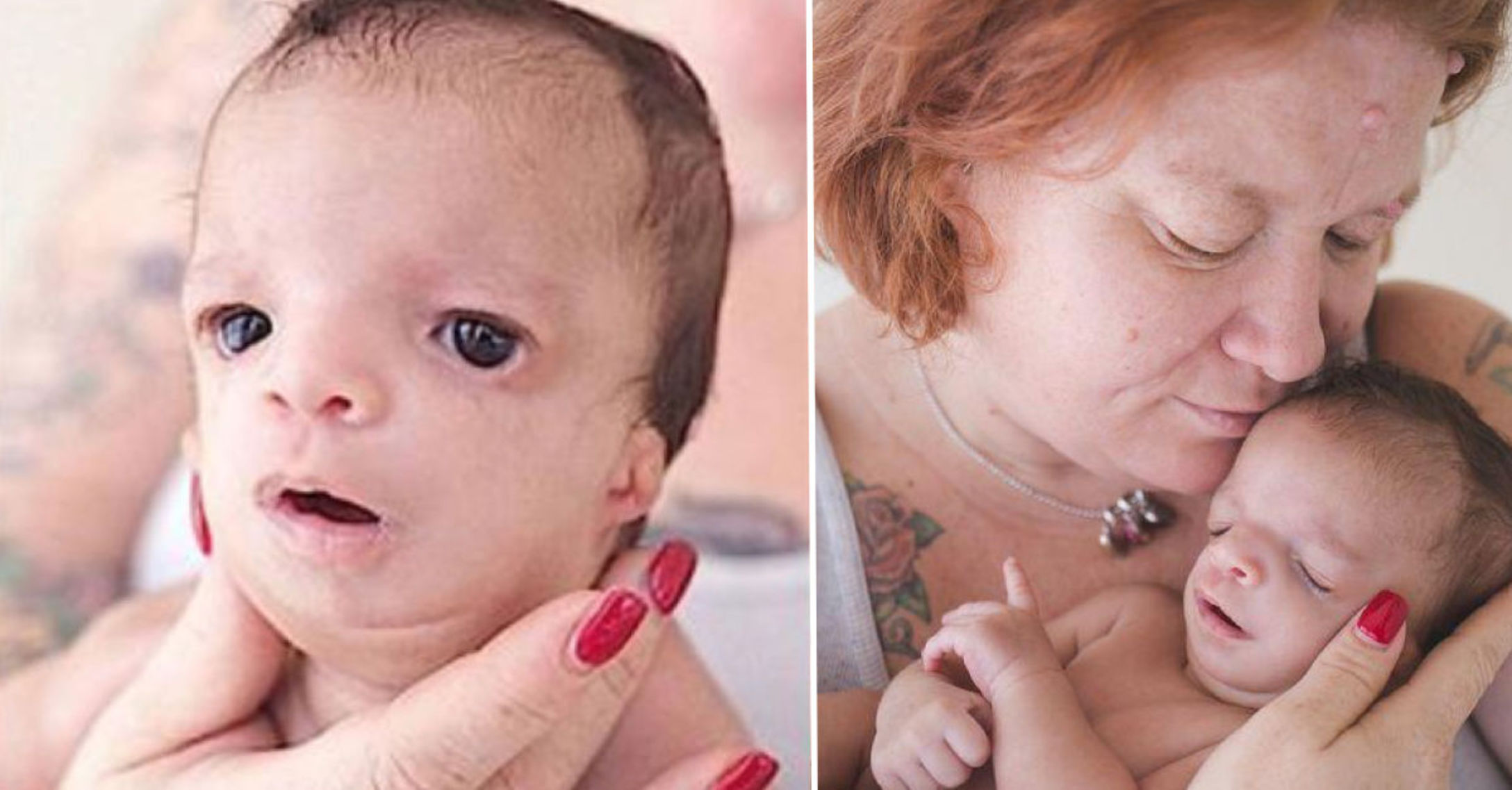 Adoptive Mom Abandons Baby With Rare Condition