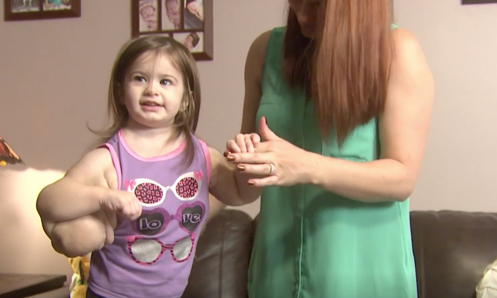 Baby With Rare Disorder Is Born Looking A 'Bodybuilder' From The Waist Up