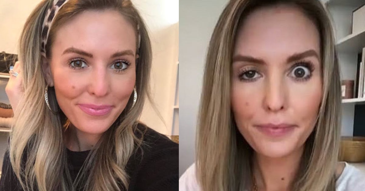 TikTok Star Left With Droopy Eyelid After Botox Treatment Goes Horribly ...