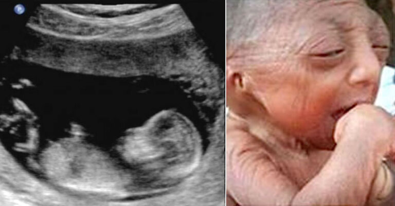 Boy With Rare Condition Looks Like Old Man