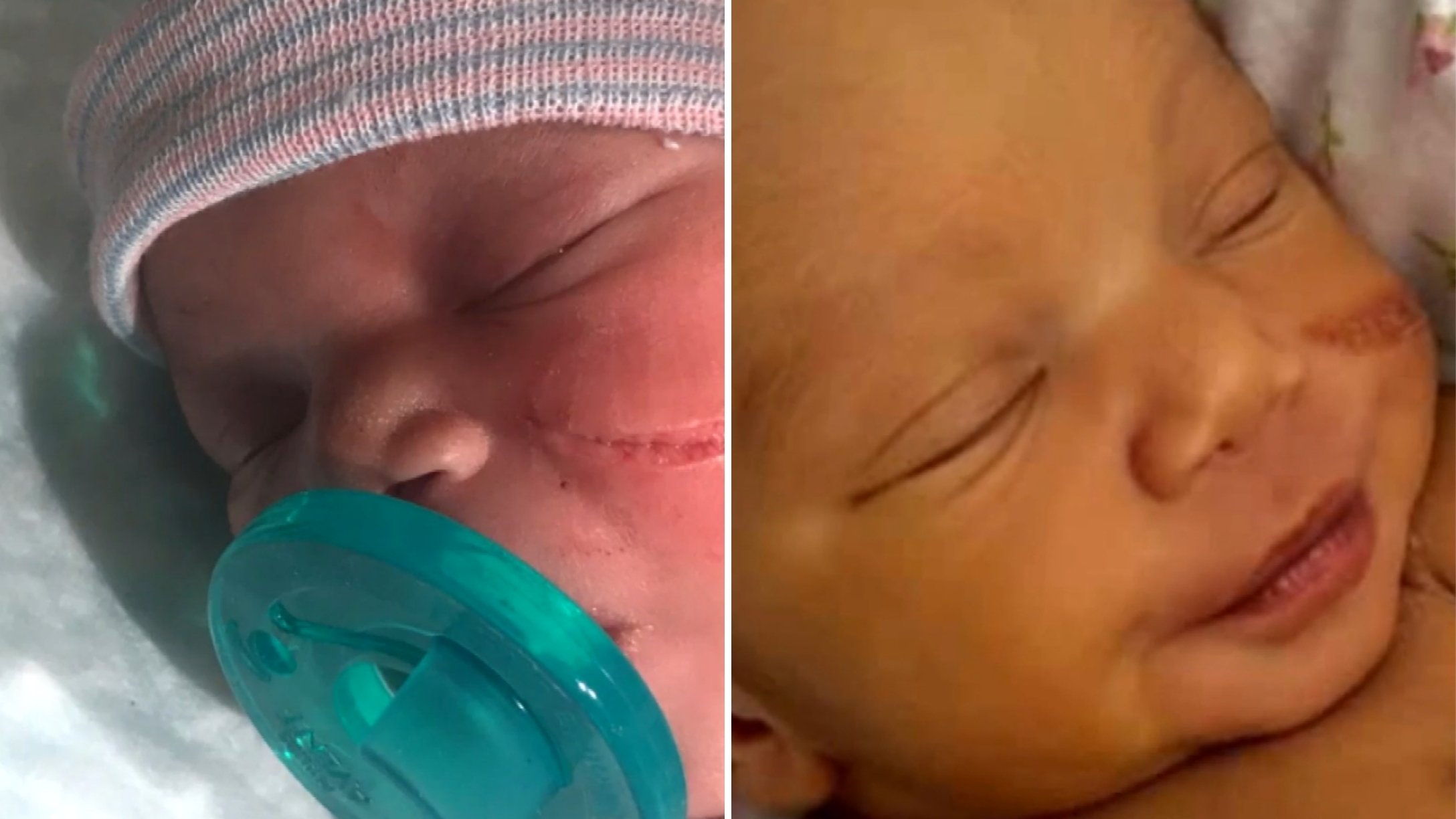 Denver Newborn Needed Stitches After Her Face Was Cut By Scalpel During ...