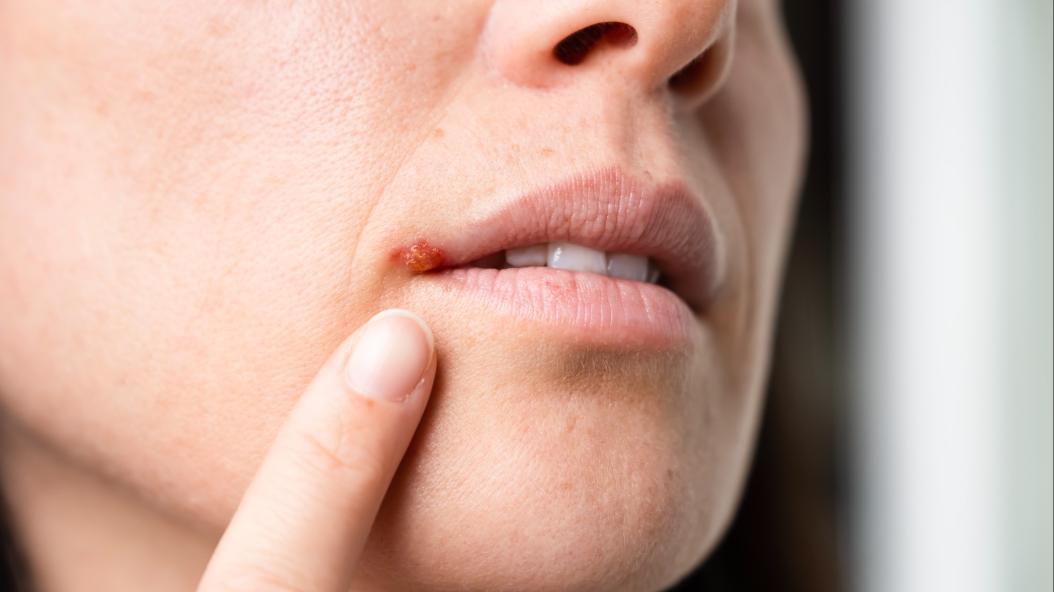 10 Things Everyone Should Know About Cold Sores