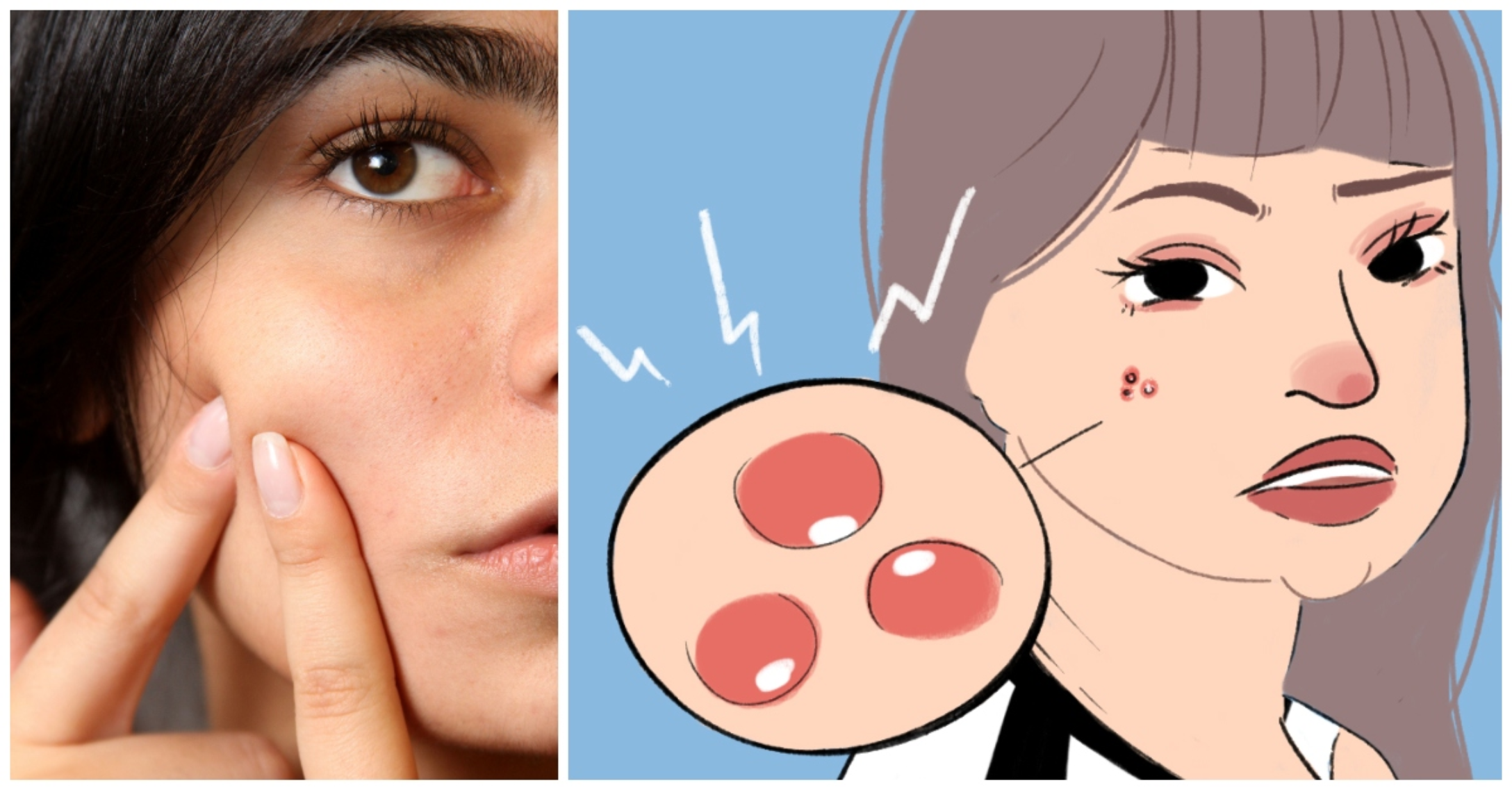 8 Types Of Skin Bumps You Should Never Try To Pop