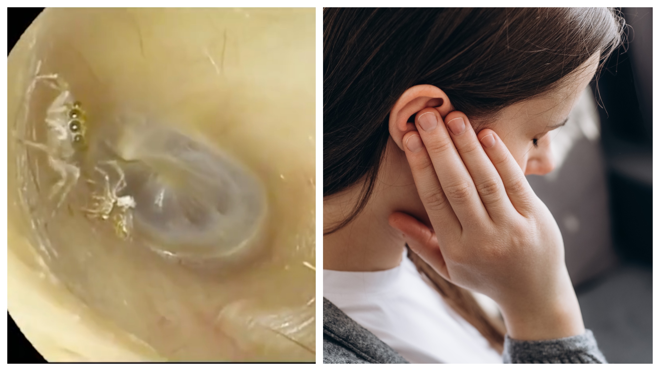Woman Hears Clicking Sound In Her Ear, Doctor Finds Spider In Her Ear Canal