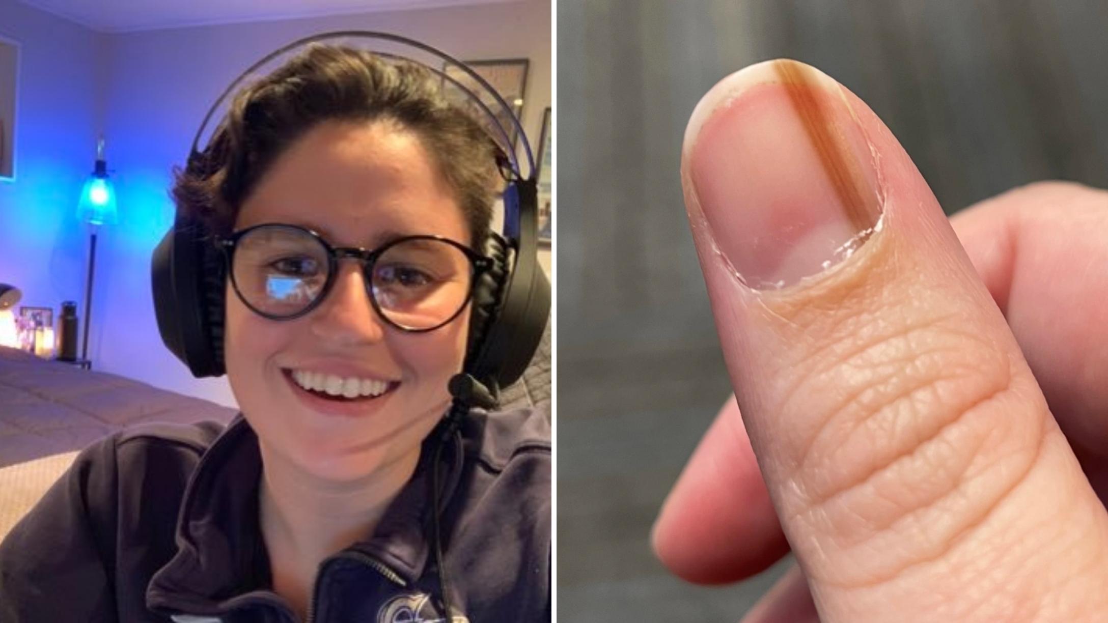 Woman Discovers Streak She's Had Under Her Nail For A Decade Is ...