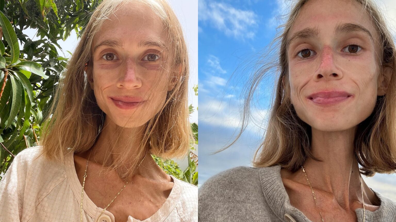 Extreme Fruitarian Influencer Found Dead Weighing 49 Pounds